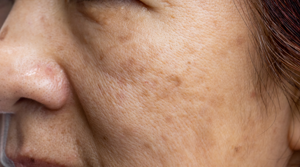 Melasma 101: Causes, Treatment & Prevention – Tuel Skincare